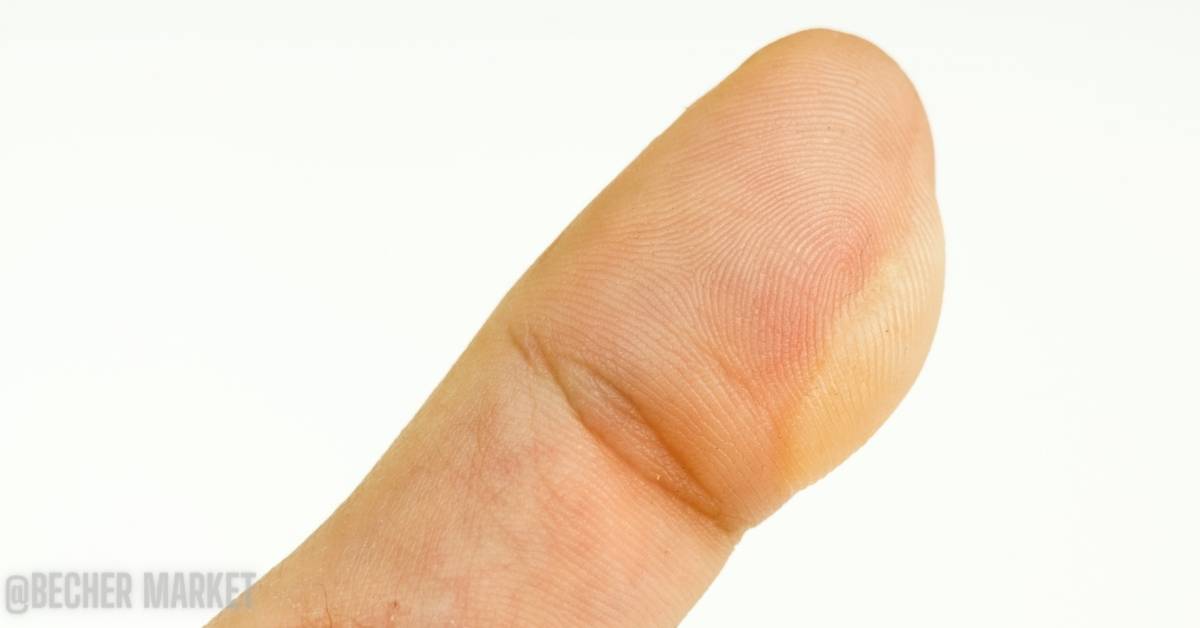 Jak Se Co Nejrychlejí Zbavit Puchýře + Nejlepší Babské Rady! [year]