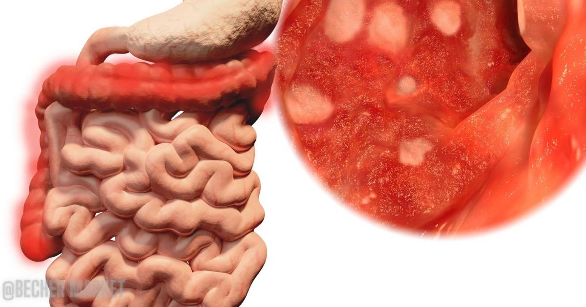 Polypy ve Střevech, Žaludku a Konečníku [Léčba & Diagnóza] [year]