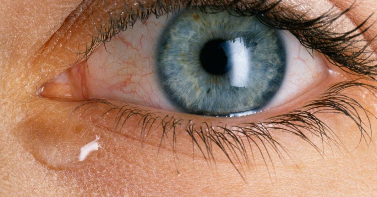 Slzení Očí: Příčiny a 9 Nejlepších Způsobů Jak Zastavit Slzení Očí!